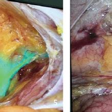 Development Of Sentinel Lymph Nodes During Operation The Blue Cluster Download Scientific