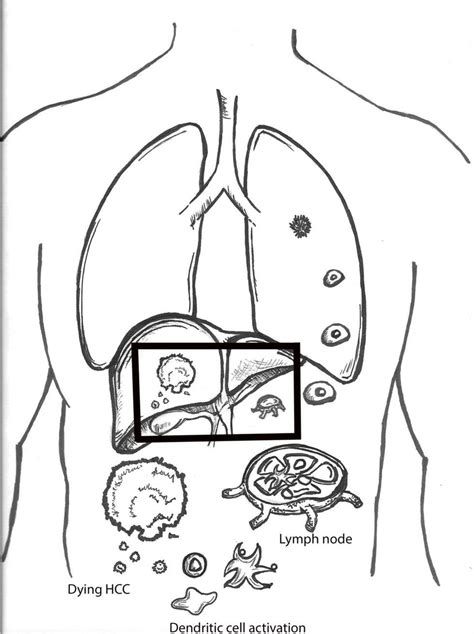 Abscopal Effect Demonstrating The Activation Of The Immune System After Download Scientific