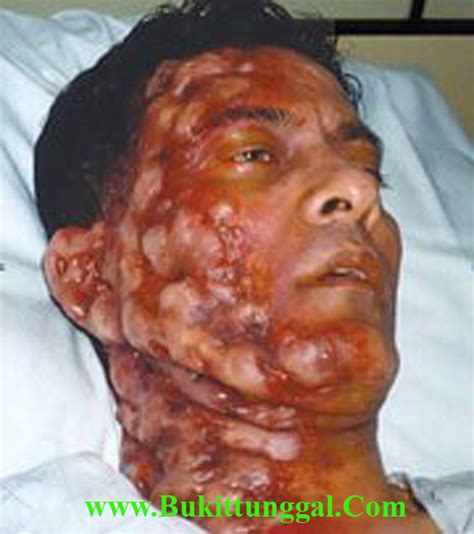 Severe Case Of Shingles R Wtf