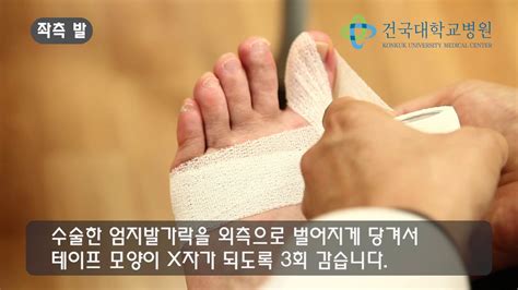족부족관절 운동법 무지 외반증 테이핑 방법 Youtube