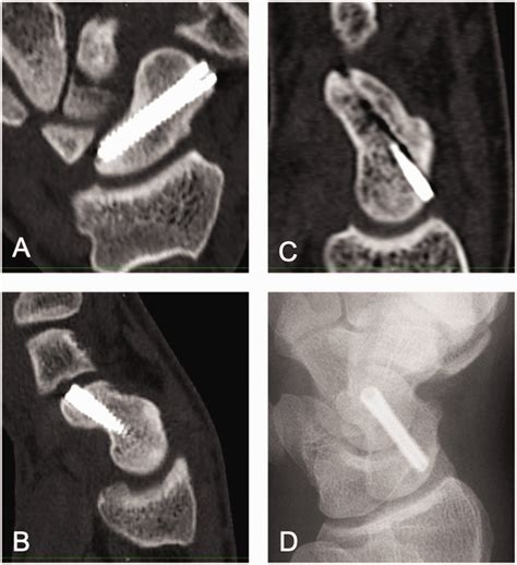 Scaphoid X Ray Angle