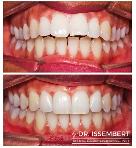 Les Avis Sur Invisalign Ce Quil Faut Savoir Tnt Review