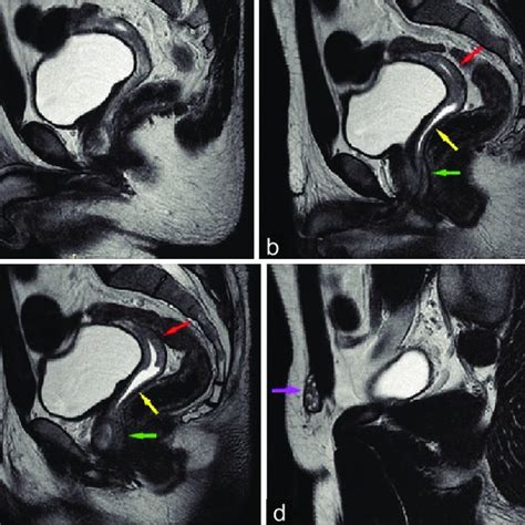 A 19 Year Old Individual With Ovotesticular Disorder Of Sex Development