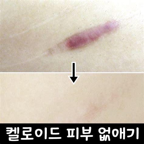 켈로이드피부 흉터치료 수술흉터제거연고 나코추천 네이버 블로그
