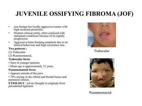 Pediatric Neoplasm Affecting The Oral Cavity Pptx
