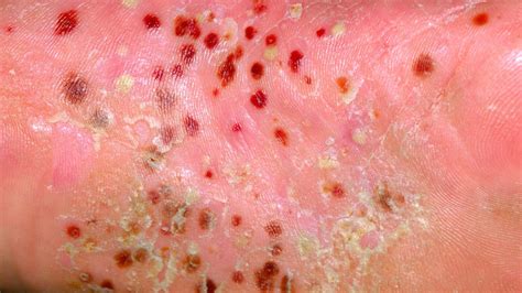 Pustular Psoriasis Causes Risk Factors Symptoms And Types