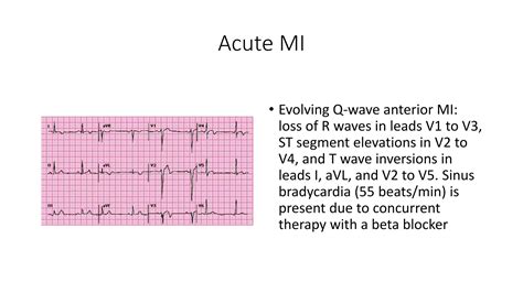 Electrocardiogram In Myocardial Infarction Pptx