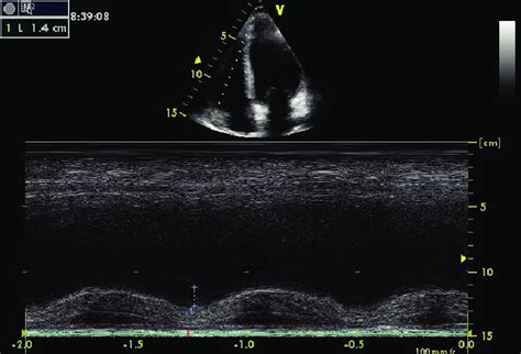 Right Ventricle Systolic Dysfunction Estimated Using Tricuspid Annular