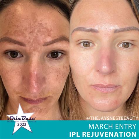 Hyperpigmentation Vs Uneven Skin Tone What Is The Difference