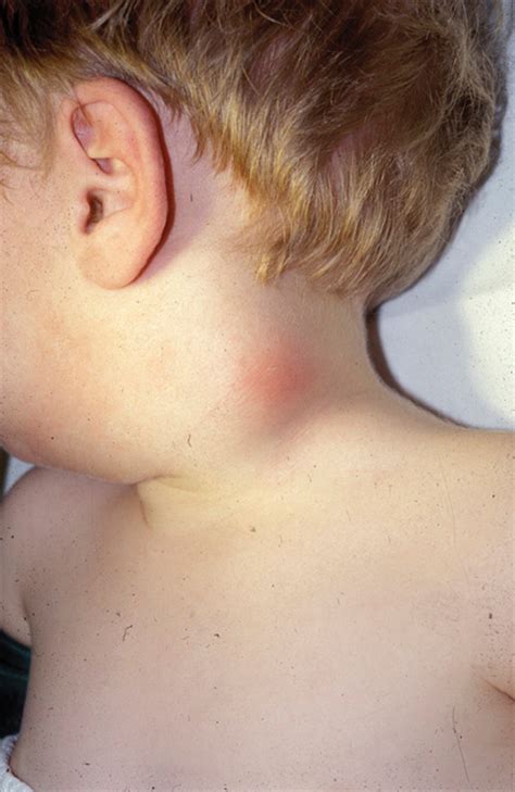 Lump On Front Of Neck