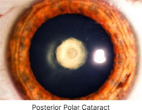 Guide To Cataracts Types Causes Treatment And More