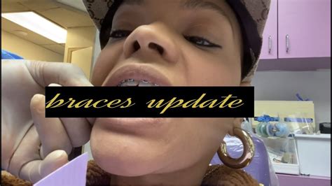 First Braces Update Vlog Of Braces Vlog Adult Braces Closing My Gap Youtube
