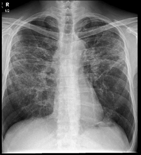 Chest X Ray Ward Round