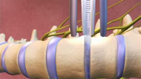 Trailer Minimally Invasive Lateral Transpsoas Approach For Lumbar Interbody Trailer Open