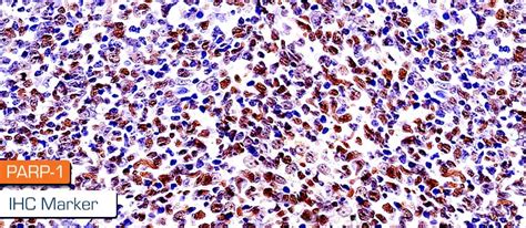 Biogenex On Linkedin Biogenex Tumordiagnosis Innovationinhealthcare