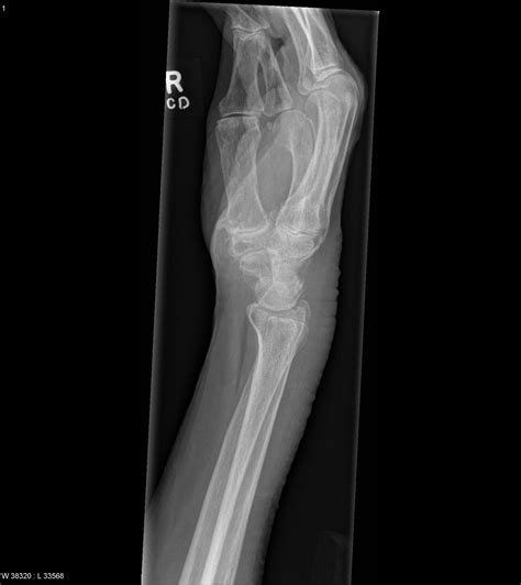File Distal Radial Fracture Triscaphe And First Carpometacarpal Joint Osteoarthritis
