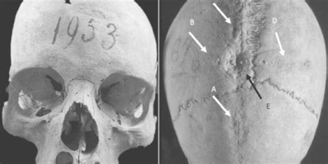 Archaeologists Found Evidence Of Trepanation On Medieval Womans Skull Rneurobiology