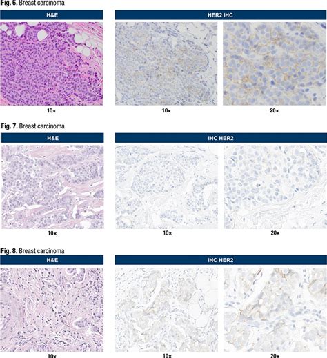 Scoring Her2 Expression Across The Full Spectrum Cap Today