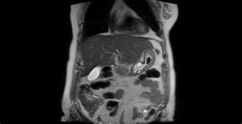 Figure 1 From Spectrum Of Findings In The Gallbladder Semantic Scholar
