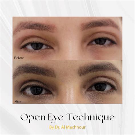 The Open Eye Technique In Dubai Transform Your Look