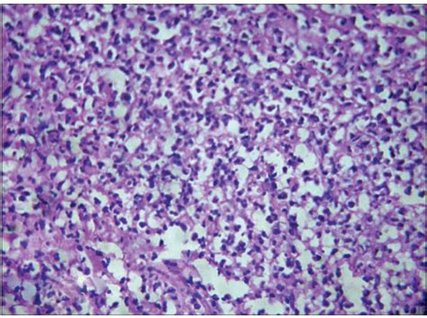 Pyoderma Gangrenosum Histology