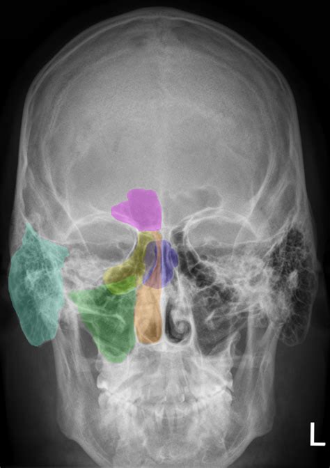 Middle Ear And Sinus Problems Skybrary Aviation Safety