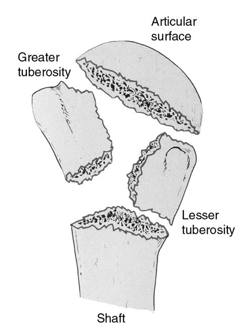 Neer Classification Of Humeral Head Fractures At Patrick Jefferson Blog