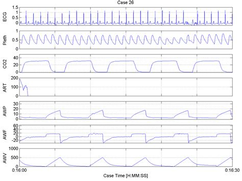 case 26 waveform plots 30 second plots