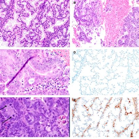 Endometrial Curettings With Both Microglandular Hyperplasia And