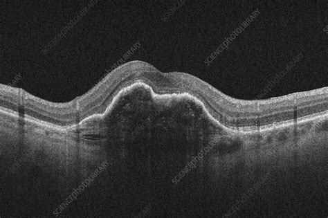 Wet Age Related Macular Degeneration Stock Image C0272008 Science Photo Library