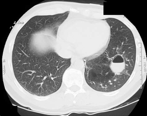 Tuberculosis Cancer Therapy Advisor