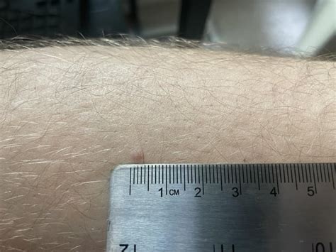 33m With Hard Bump On Shin Probably Developed In The Last Few Months