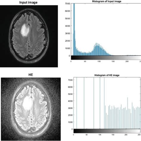 Brightness Preserving Bi Histogram Equalization For Brain Tumor Download Scientific Diagram