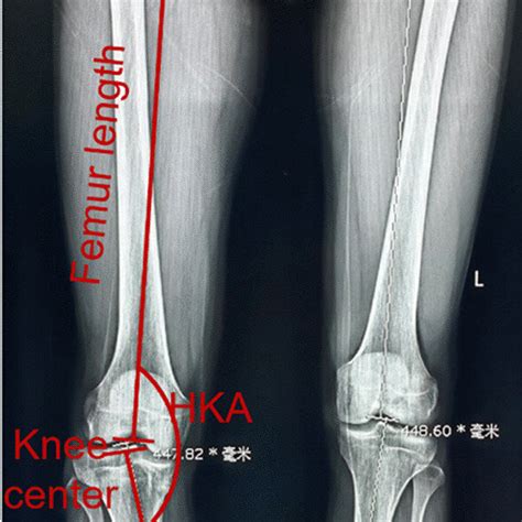 The Measurement Of Lower Limb Discrepancy And Alignment Lower Limb