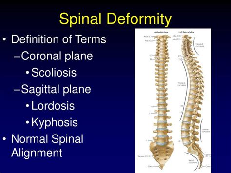 Ppt Spinal Deformity And Degeneration Powerpoint Presentation Id244232