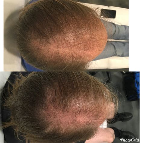 Prp Hair Loss Therapy Las Vegas Platelet Rich Plasma Nevada