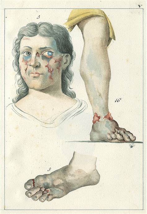 Lower Extremity Amputation Compound Fractures Free Photo Illustration Rawpixel