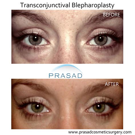 Is Lower Blepharoplasty Permanent Dr Prasad Blog