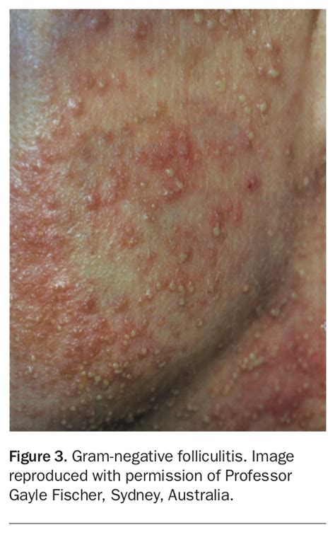 Folliculitis Diagnosis And Management Of Subtypes Medicine Today