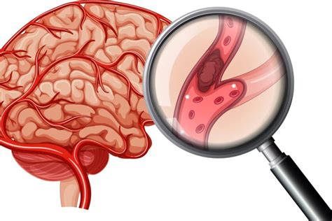 Endovascular Stroke Treatment Explained By Dr Sumit Kapadia