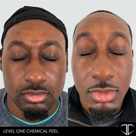 Charette Cosmetics Medical Spa Elbow Hyperpigmentation Scarring ️