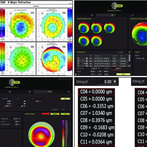 Case 4 A Refractive 4 Map On Pentacam Showing Small Zone Of