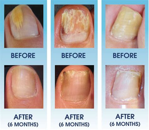 Can You Get Fungal Nail Treatment On Nhs At Hayley Matters Blog