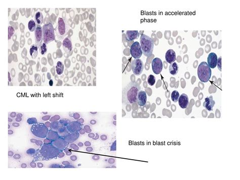 Ppt Mlab 1415 Hematology Keri Brophy Martinez Powerpoint