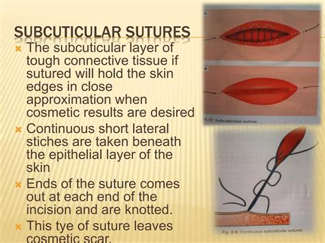 Incision Suture And Suture Meteri Al Pptx