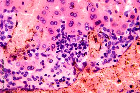 Coccidia In Liver Photomicrograph Showing Intracellular Parasitic