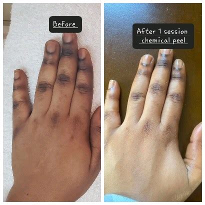 Dark Knuckles Before And After