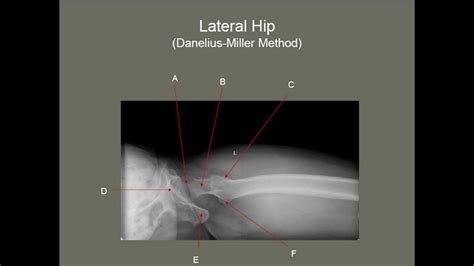 X Table Hip Proximal Lateral Femur Diagram Quizlet