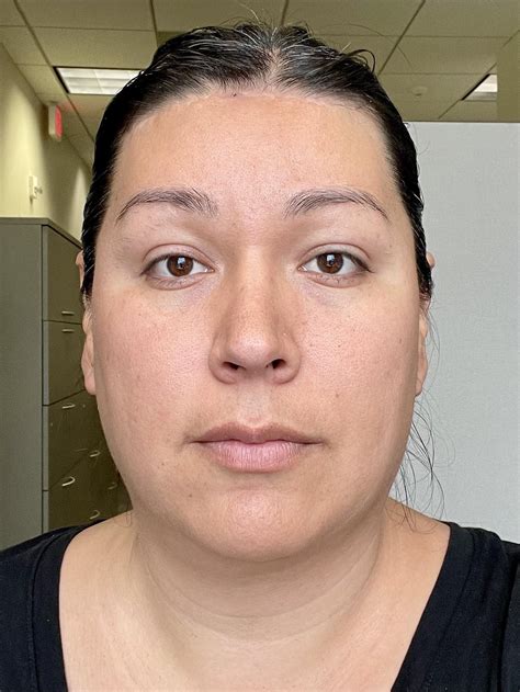 1 Year Post Ffs Dr James Lee Kaiser West La R Transgender Surgeries