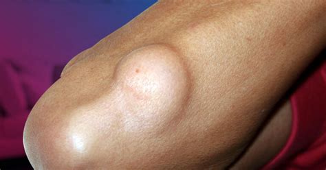 Protuberancias Bajo La Piel Pueden Ser Sarcoma Alerta El Imss Hidalgo La Verdad Hidalgo